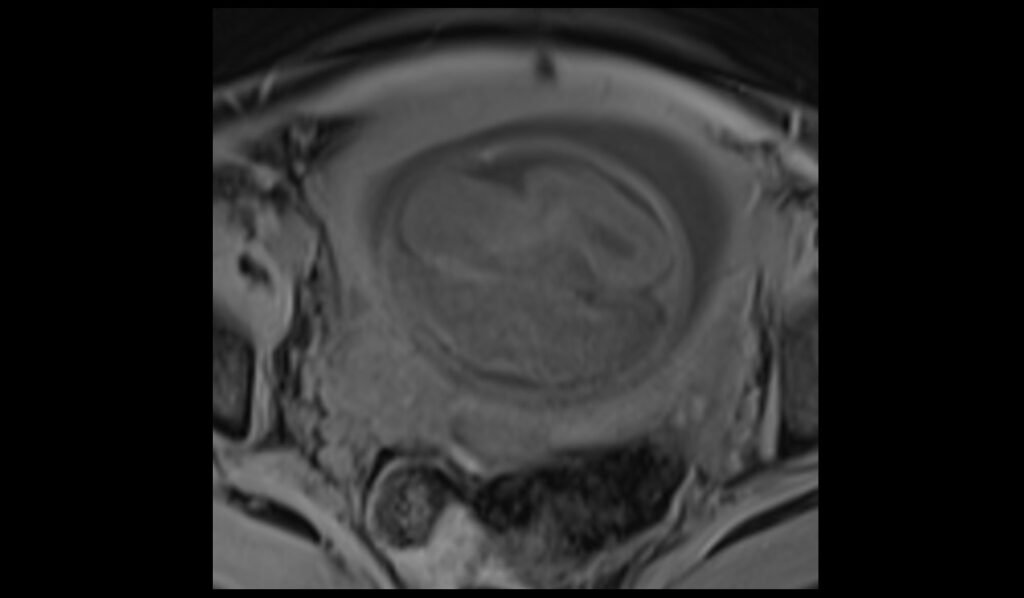 fetal brain mri axial t1 images