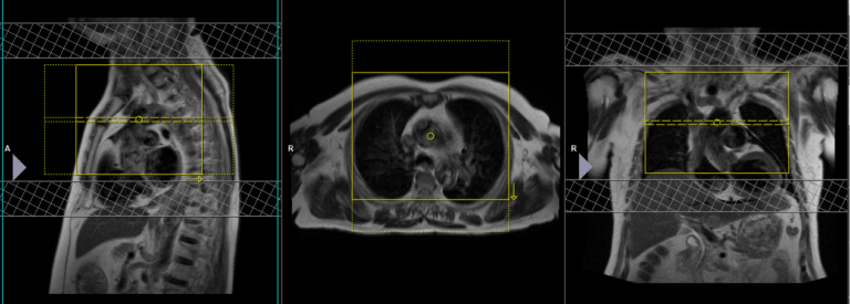 Thymus MRI | Thymic cyst mri protocol and planning |Thymoma mri
