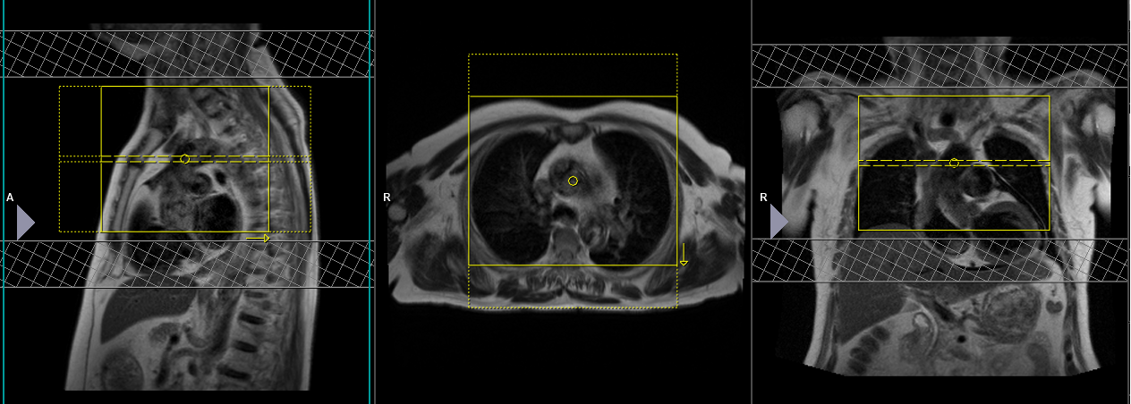 Thymus MRI | Thymic cyst mri protocol and planning |Thymoma mri
