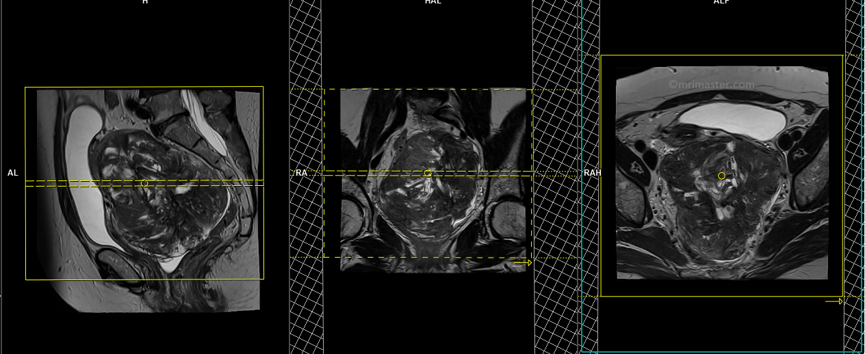 Uterine Fibroid MRI Protocol | Fibroid Mapping MRI Protocol and Planning