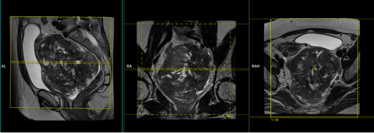 Uterine Fibroid MRI Protocol | Fibroid Mapping MRI Protocol and Planning