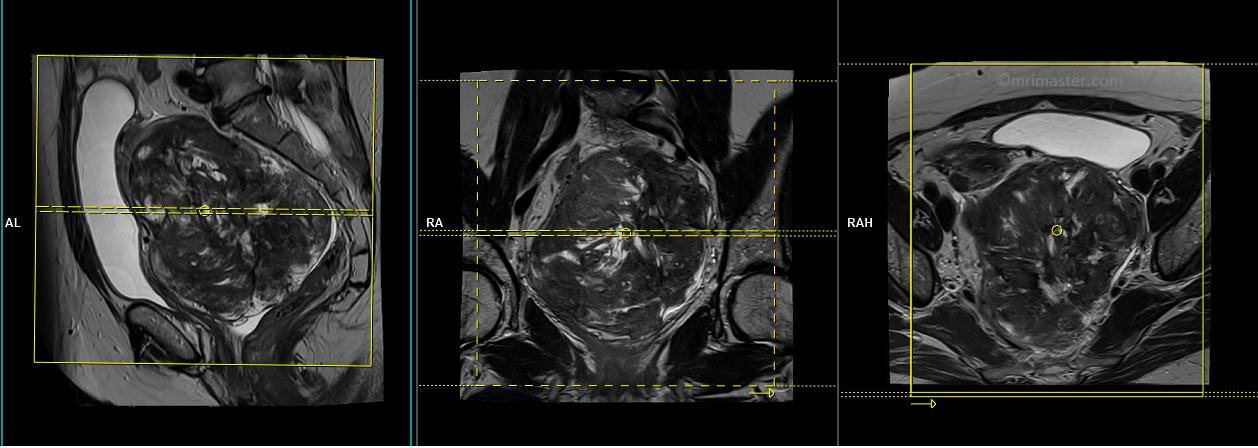 Uterine Fibroid MRI Protocol | Fibroid Mapping MRI Protocol and Planning