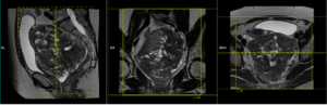 Uterine Fibroid MRI Protocol | Fibroid Mapping MRI Protocol and Planning