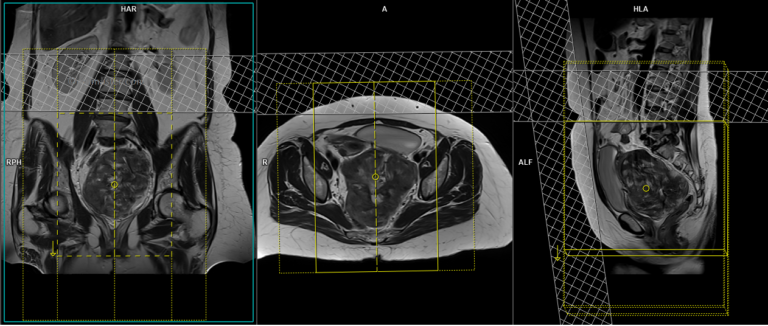 Uterine Fibroid MRI Protocol | Fibroid Mapping MRI Protocol and Planning