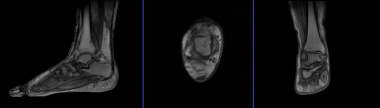 Ankle MRI Protocols and Planning | Indications for Ankle MRI Acan