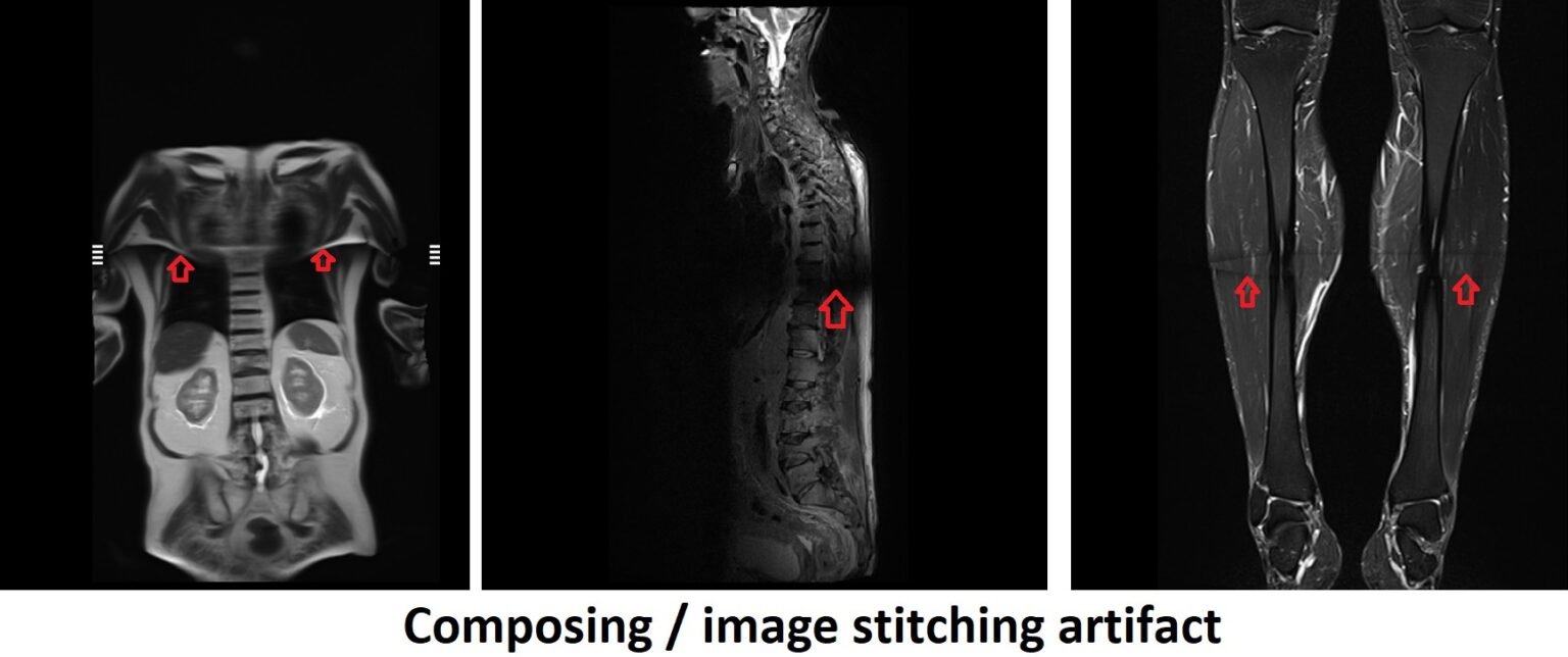 MRI composing/ Image stitching artifact