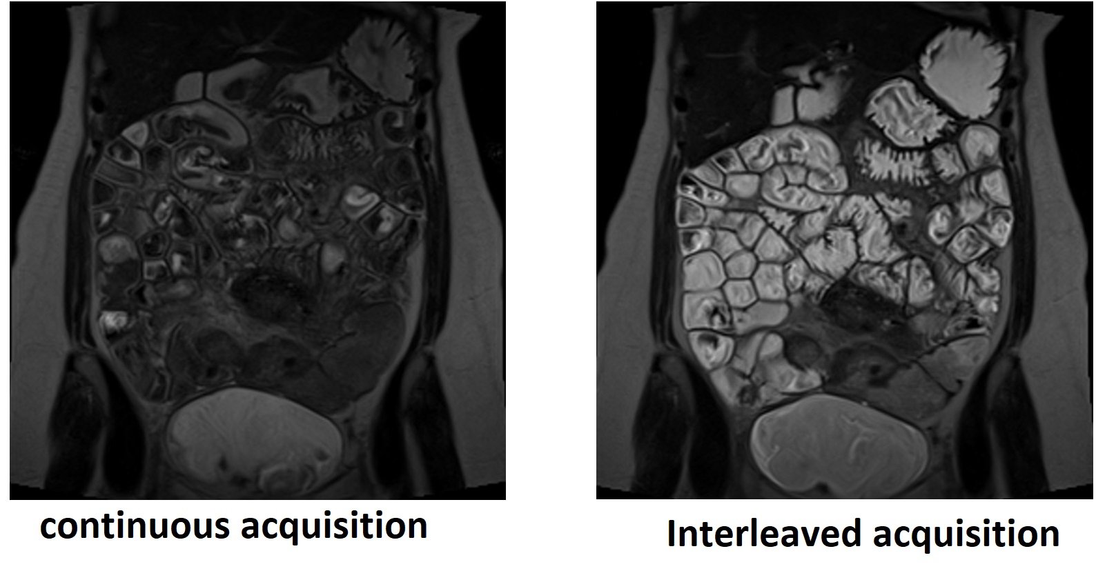 Cross talk artifact MRI | Cross excitation or Slice-overlap artifact