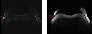 Fat water swap artifact MRI