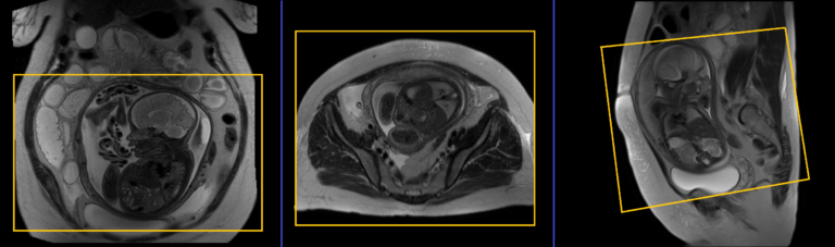 Fetal abdominal MRI | Fetal abdominal MRI protocol and planning