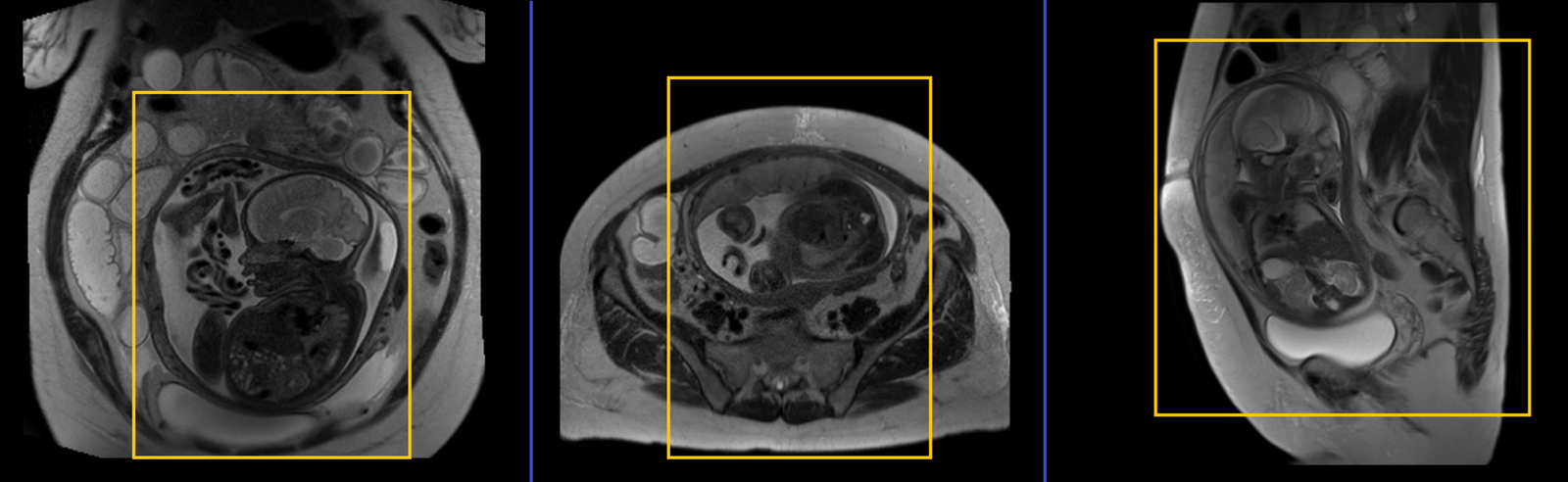 Fetal abdominal MRI | Fetal abdominal MRI protocol and planning