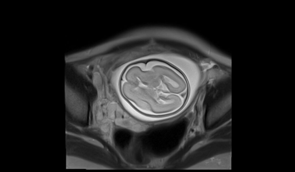 fetal brain mri axial localiser images - mrimaster