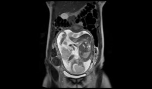 fetal brain mri localiser - mrimaster