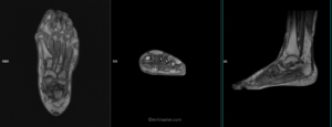 MRI forefoot | MRI forefoot protocol and planning