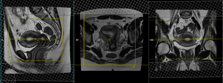 Gynaecologic MRI Pelvis (Uterus,Cervix and Adnexal) Protocols and ...