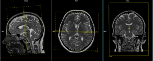 Cerebrospinal fluid flow MRI | CSF flow MRI protocol and planning