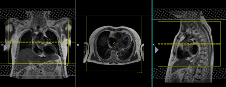 Chest MRI Protocols and Planning | Indications for MRI Chest Scan