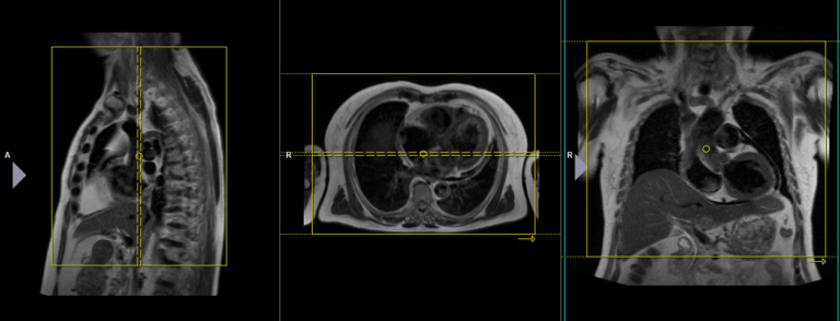 Chest MRI Protocols and Planning | Indications for MRI Chest Scan