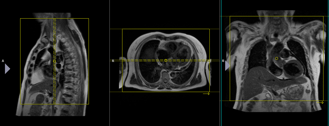 Chest MRI Protocols and Planning | Indications for MRI Chest Scan