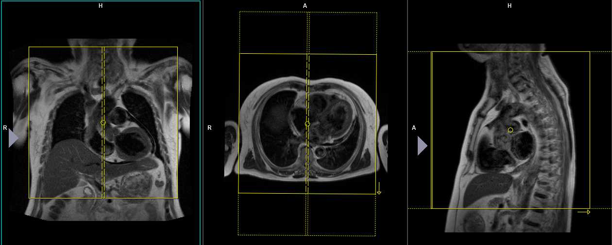 Chest MRI Protocols and Planning | Indications for MRI Chest Scan