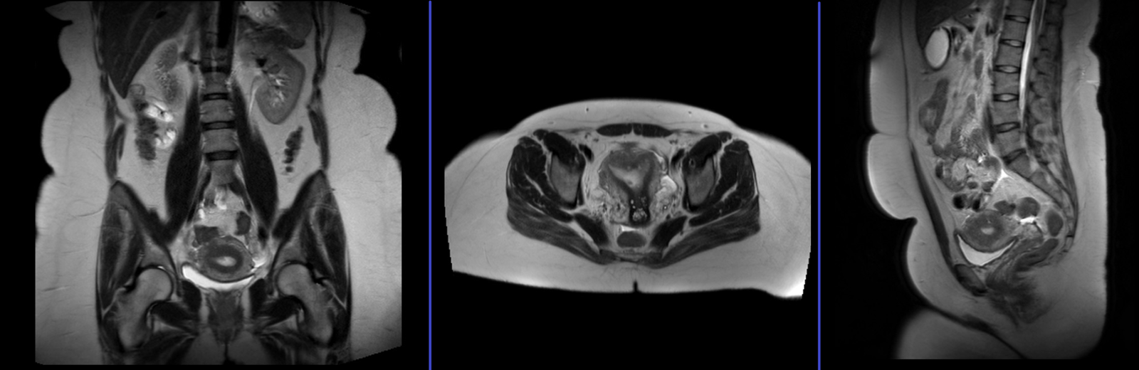 Gynaecologic MRI Pelvis (Uterus,Cervix and Adnexal) Protocols and ...