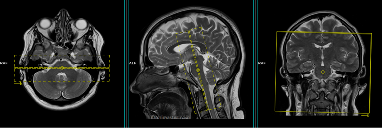 Internal Auditory Meatus(IAMS) MRI Protocols and Planning | Indications ...