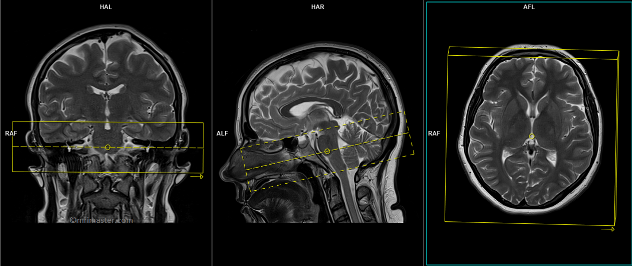 Internal Auditory Meatus(IAMS) MRI Protocols and Planning | Indications ...