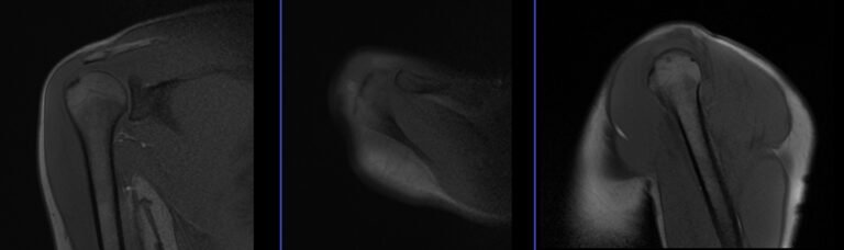Shoulder MRI planning | MRI shoulder protocols | Indications for MRI ...