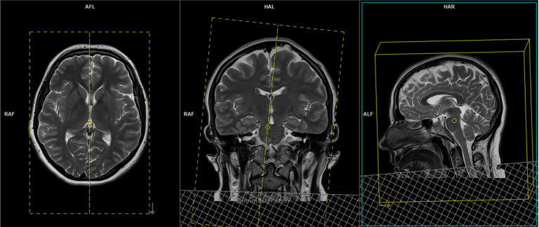 MRV Brain Planning | MRV Brain Protocols | Indications for MRV Brain Scan