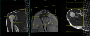 Shoulder MRI planning | MRI shoulder protocols | Indications for MRI ...