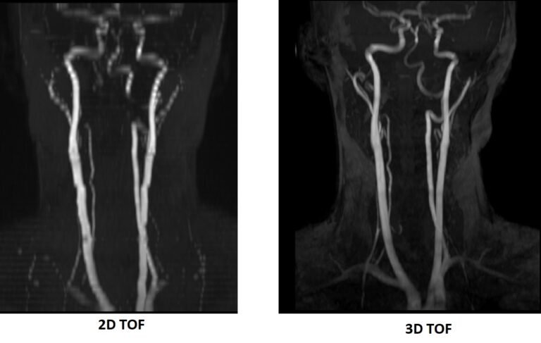 Stair step 2D TOF Artifact | MRA TOF Artifact
