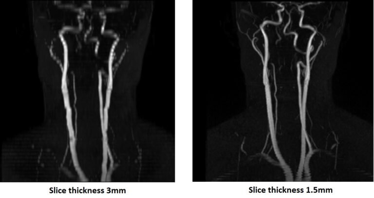 Stair step 2D TOF Artifact | MRA TOF Artifact