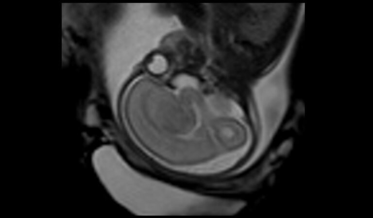 fetal brain mri sagittal haste image