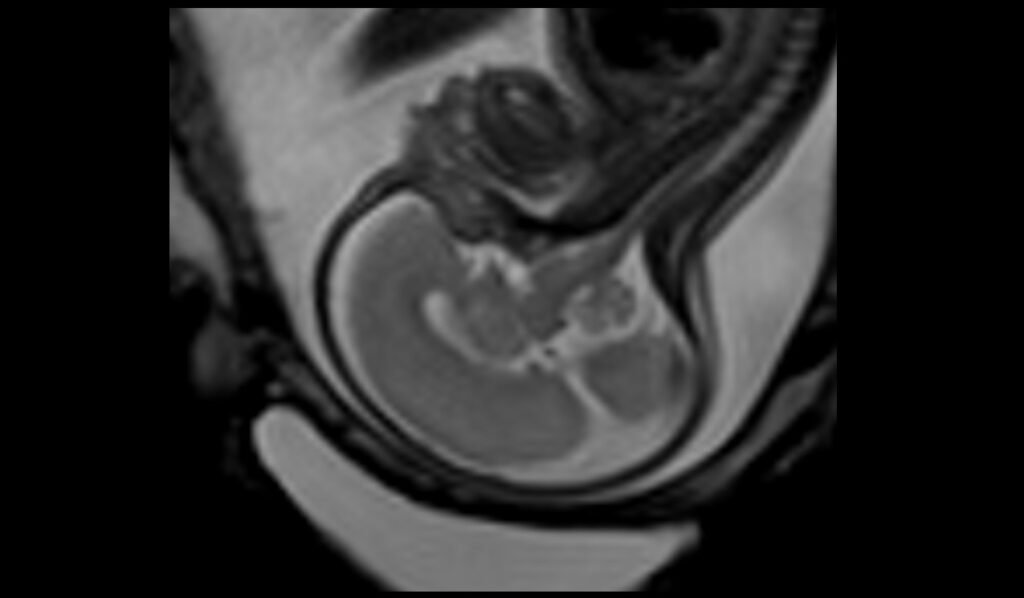 fetal brain mri sagittal haste image