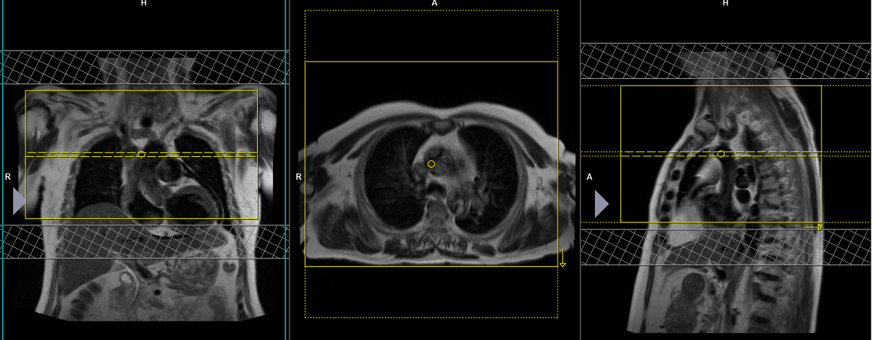 Thymus MRI | Thymic cyst mri protocol and planning |Thymoma mri