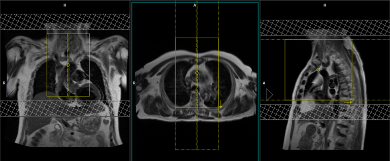 Thymus MRI | Thymic cyst mri protocol and planning |Thymoma mri