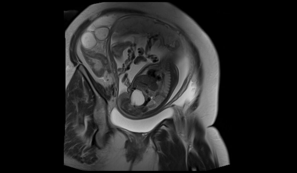 fetal abdomen mri coronal fetal abdomen localiser
