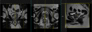 MRI Prostate Protocols | MRI Prostate Cancer Multiparametric planning