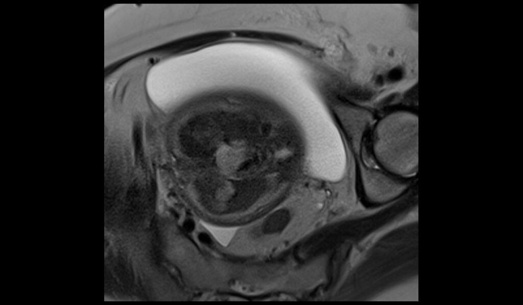 fetal abdomen mri axial small fov images