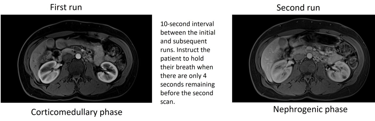 MRI Kidneys (Renal) Planning | MRI Kidneys Protocol and Indications