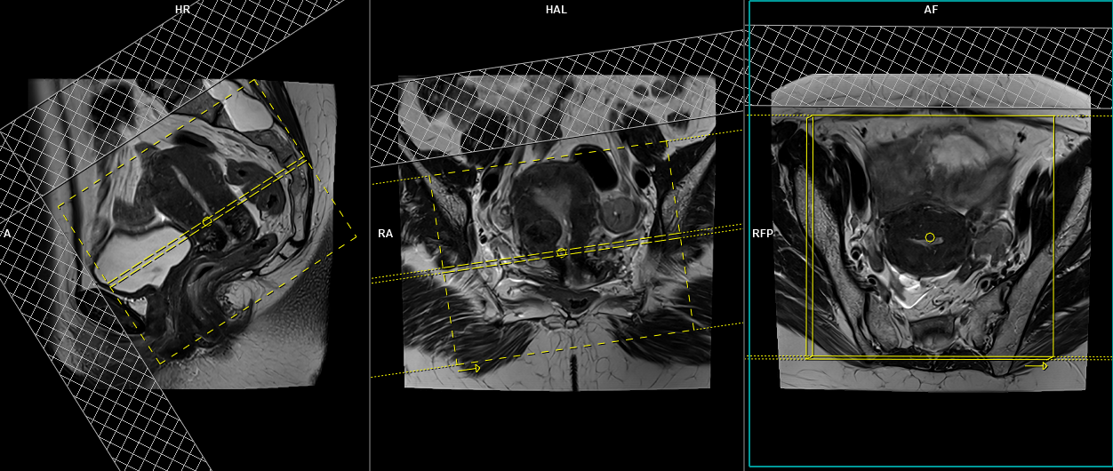 MRI CA Cervix Protocol and Planning