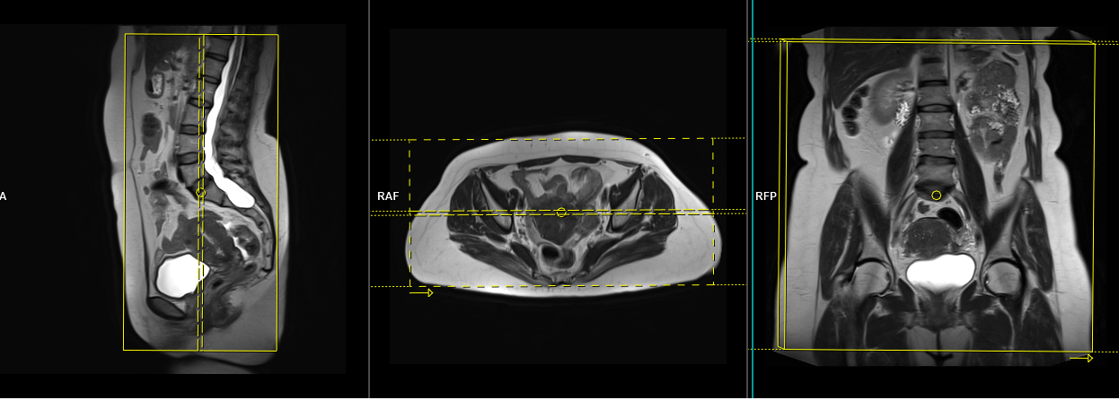MRI CA Cervix Protocol and Planning