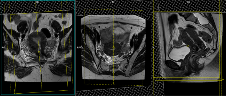 MRI CA Cervix Protocol and Planning