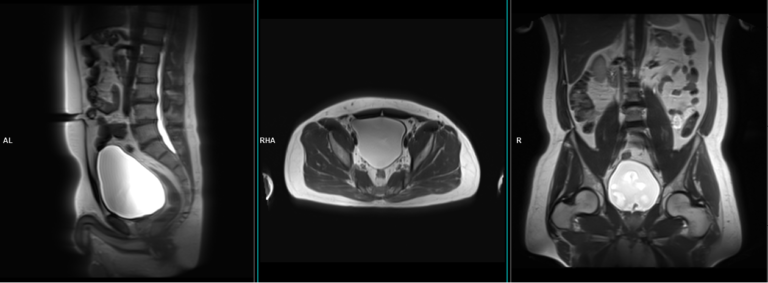 Urinary bladder MRI Protocols and Planning | Indications for MRI ...
