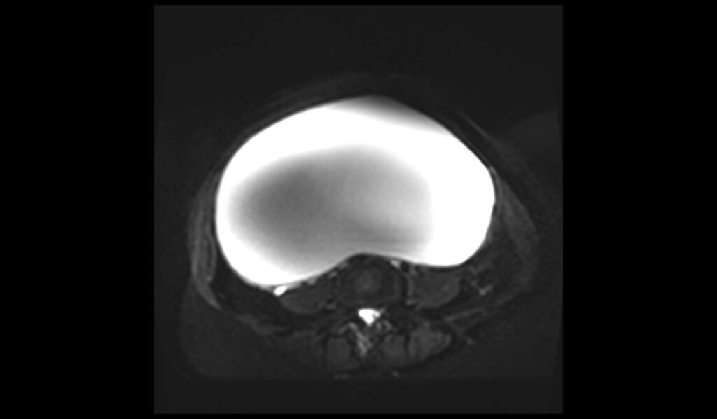 MRI Large abdomen and Pelvic Masses DWI images