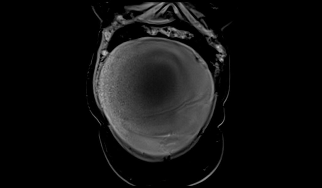 MRI Large abdomen and Pelvic Masses VIBE coronal dynamic images