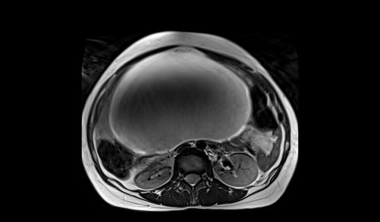 MRI Large abdomen and Pelvic Masses t2 axial images - mrimaster