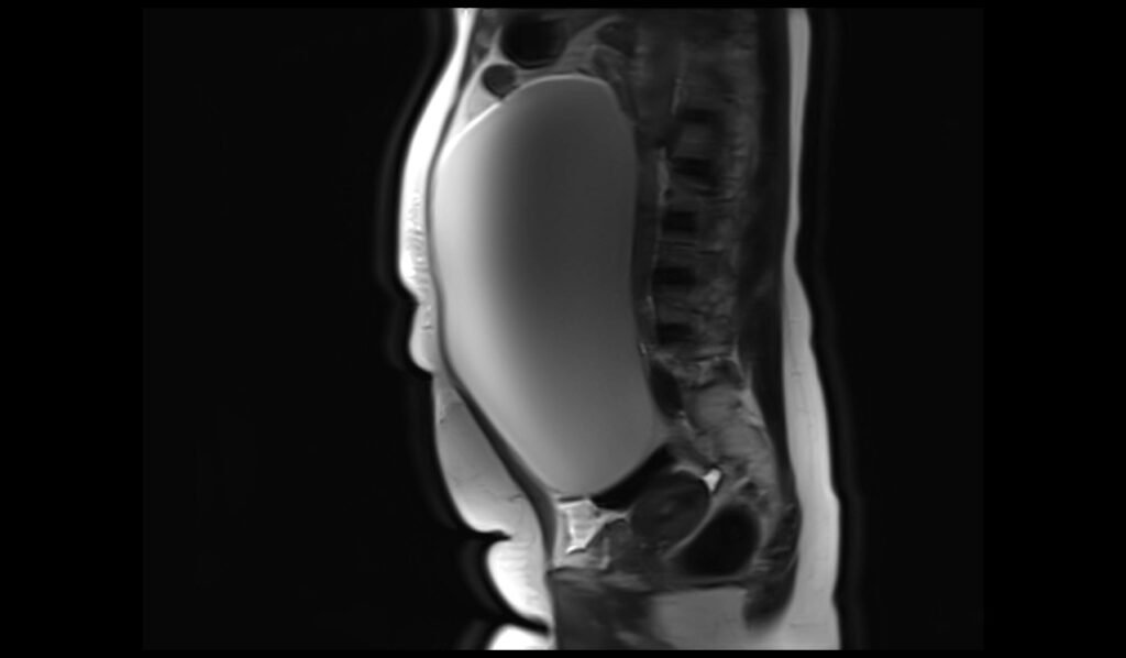 MRI Large abdomen and Pelvic Masses localiser images - mrimaster