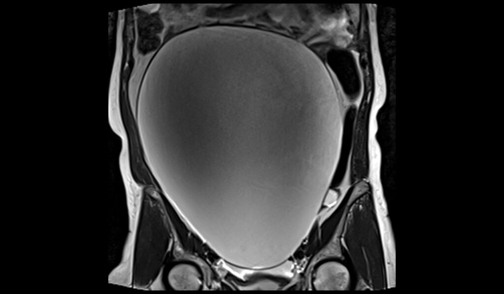 MRI Large abdomen and Pelvic Masses T2 coronal images - mrimaster