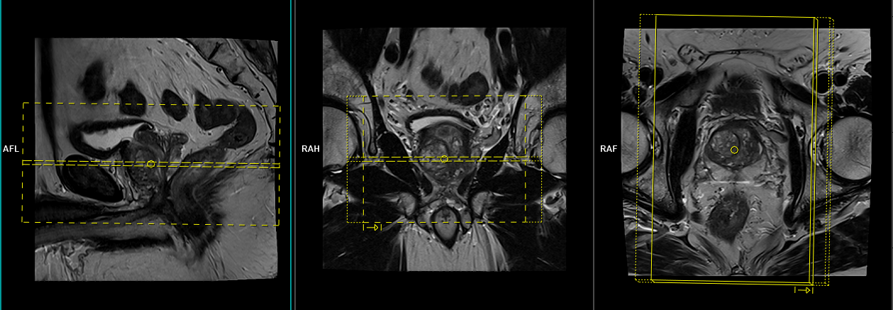 MRI Prostate Planning | Dynamic MRI Prostate Protocols