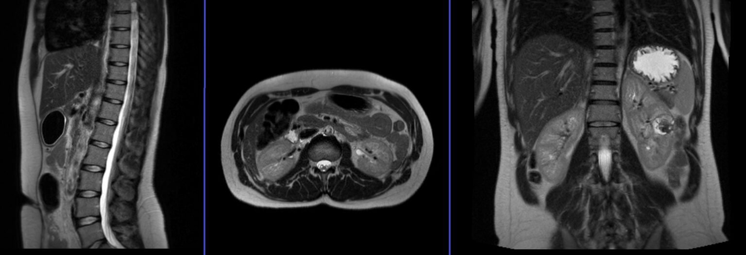 MRI Renal Angiography (MRA kidneys) Protocols and Planning and Indications